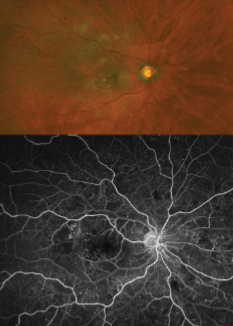 Diabetic Retinopathy | EYLEA® (aflibercept) Injection
