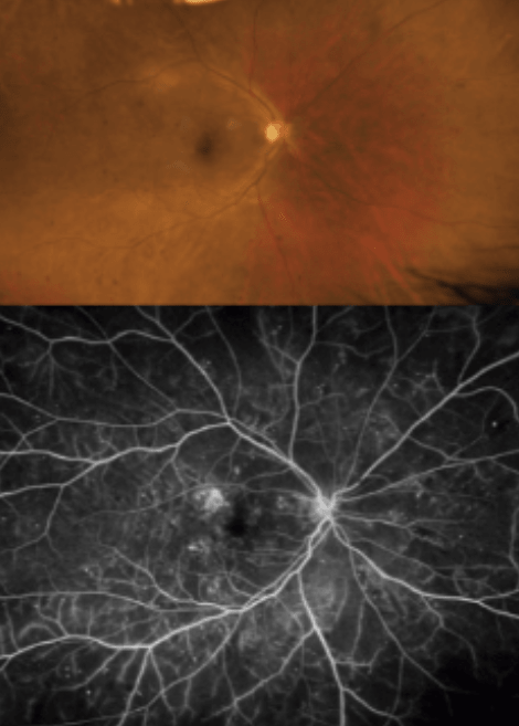 Diabetic Retinopathy | EYLEA® (aflibercept) Injection