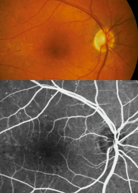 Diabetic Retinopathy | EYLEA® (aflibercept) Injection