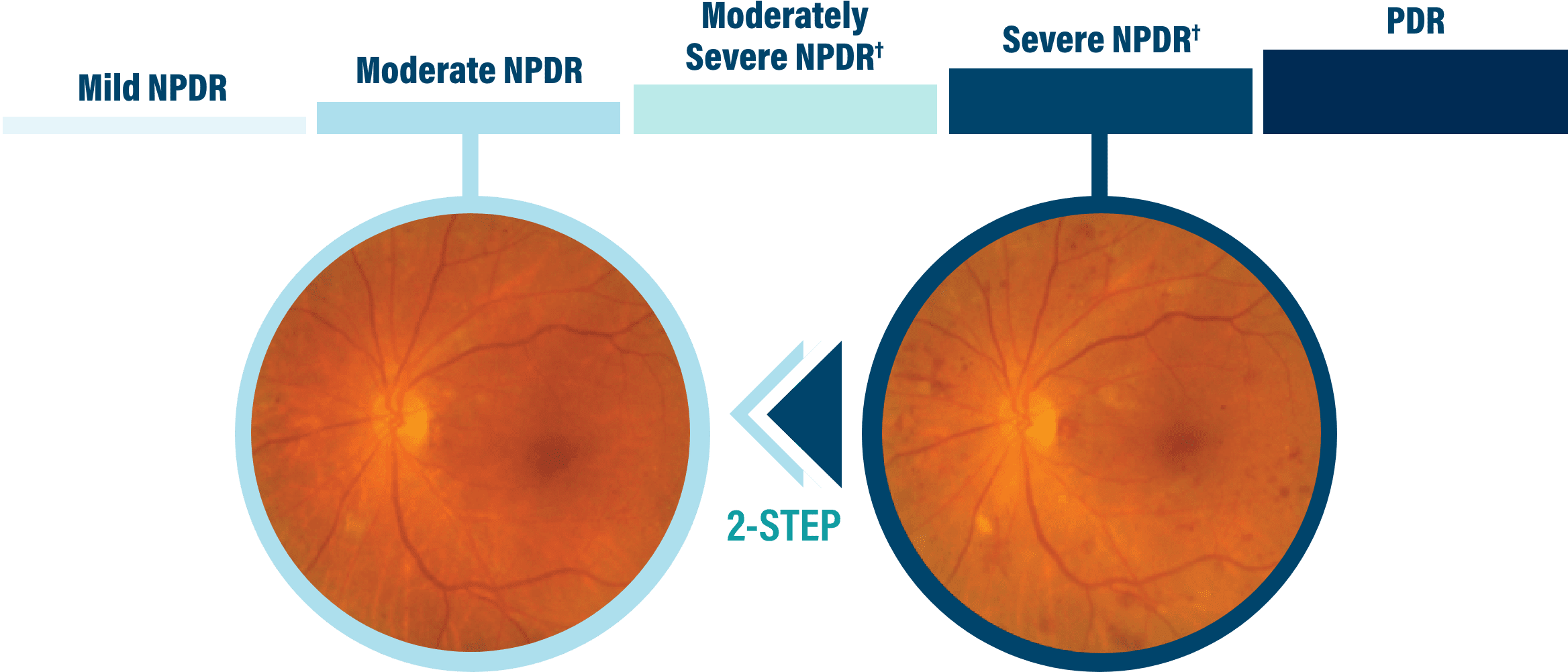Diabetic Retinopathy Eylea® Aflibercept Injection