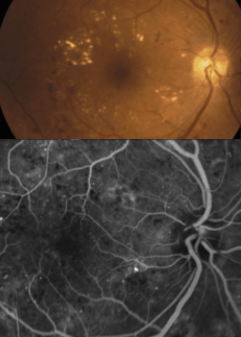 Diabetic Retinopathy | EYLEA® (aflibercept) Injection